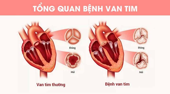 Tìm hiểu về van tim và các bệnh van tim thường gặp - Phòng Khám Sài Gòn ...