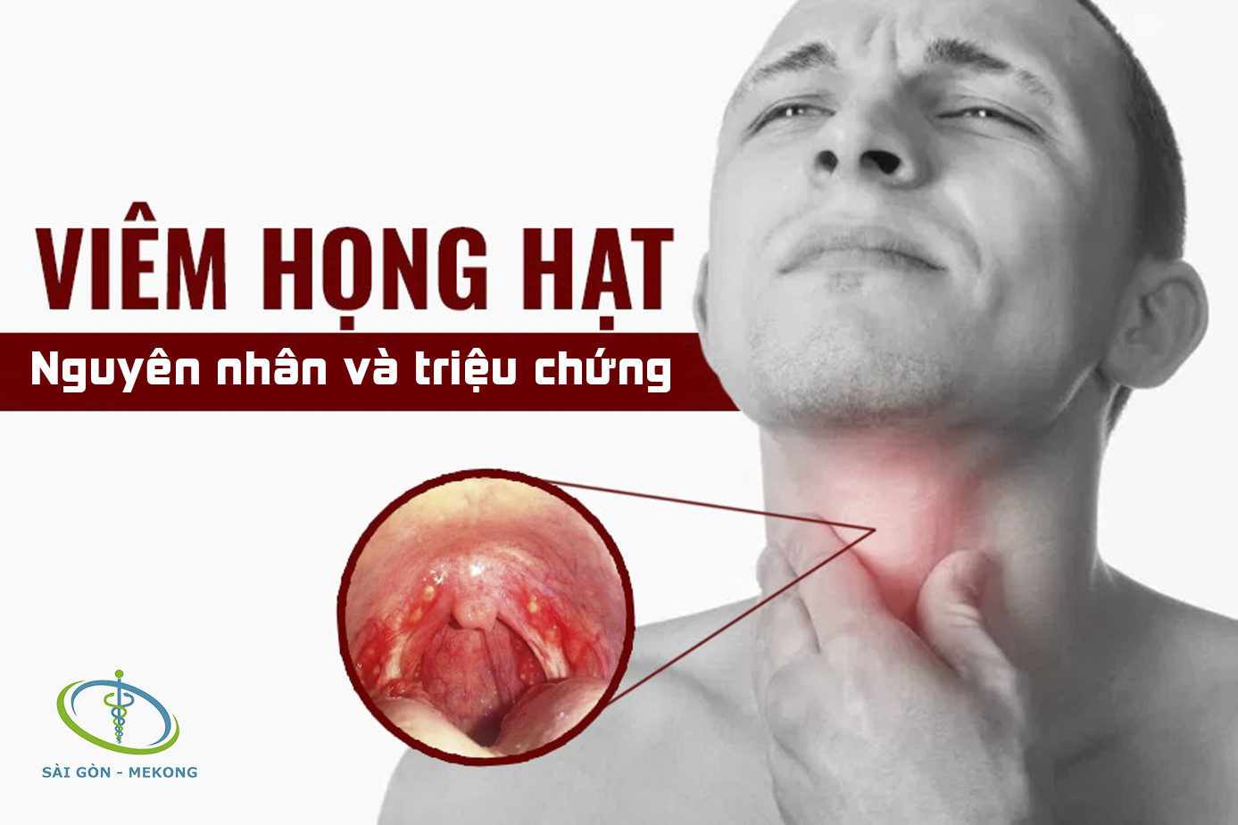 Viêm họng hạt: Nguyên nhân và triệu chứng - Phòng Khám Sài Gòn Mekong
